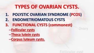 Ovarian cysts | PPTX