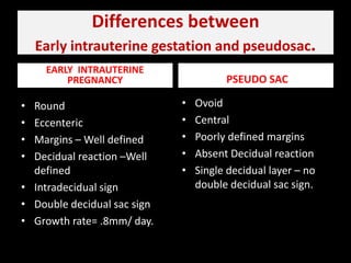 Ovarian ectopic pregnancy | PPTX