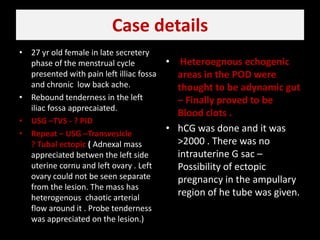 Ovarian ectopic pregnancy | PPTX