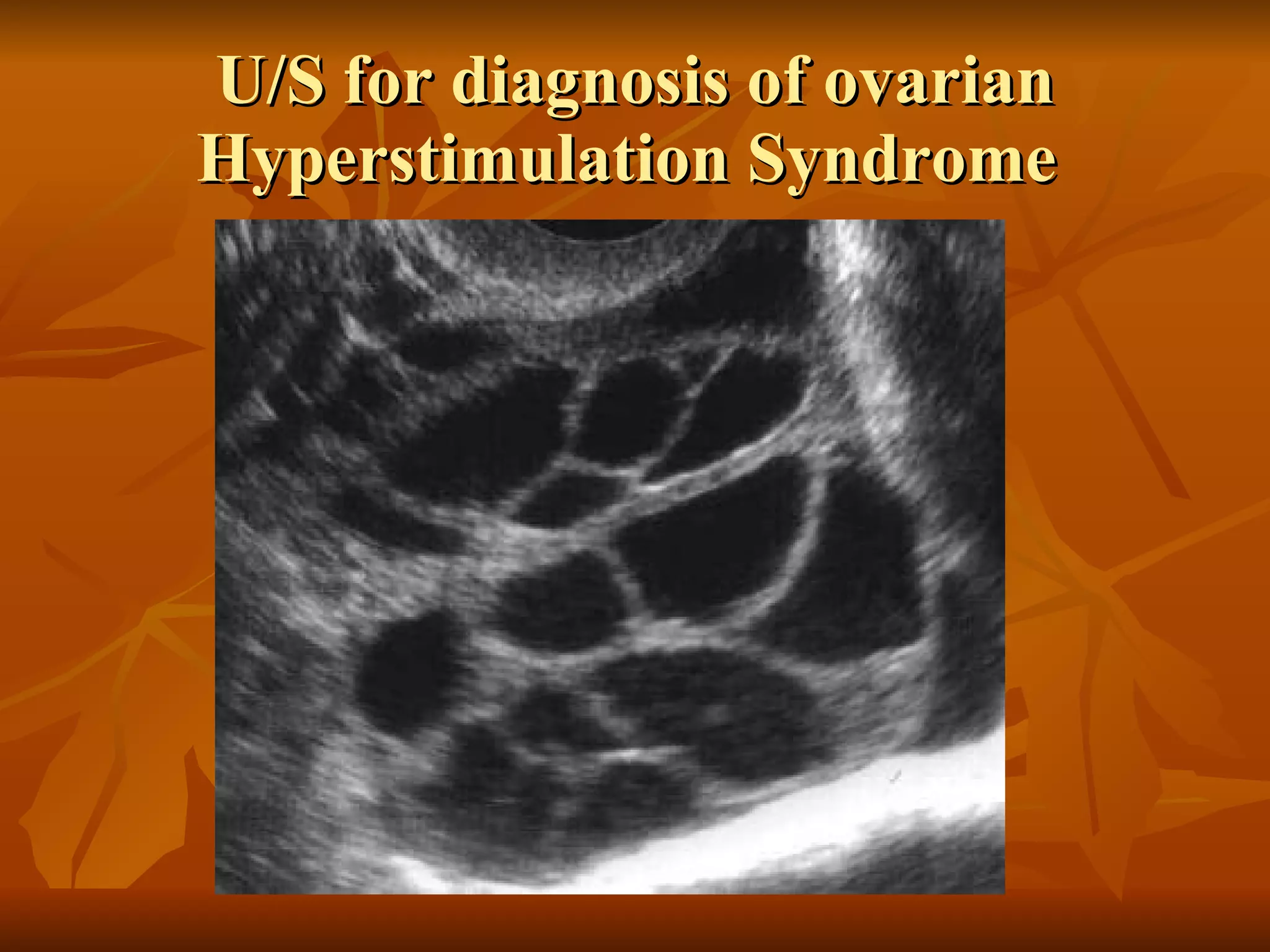 Ovarian Hyperstimulation Syndrome | PPT