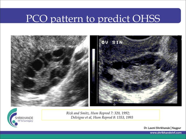 Ovarian hyper stimulation syndrome ohss | PPT | Infertility ...