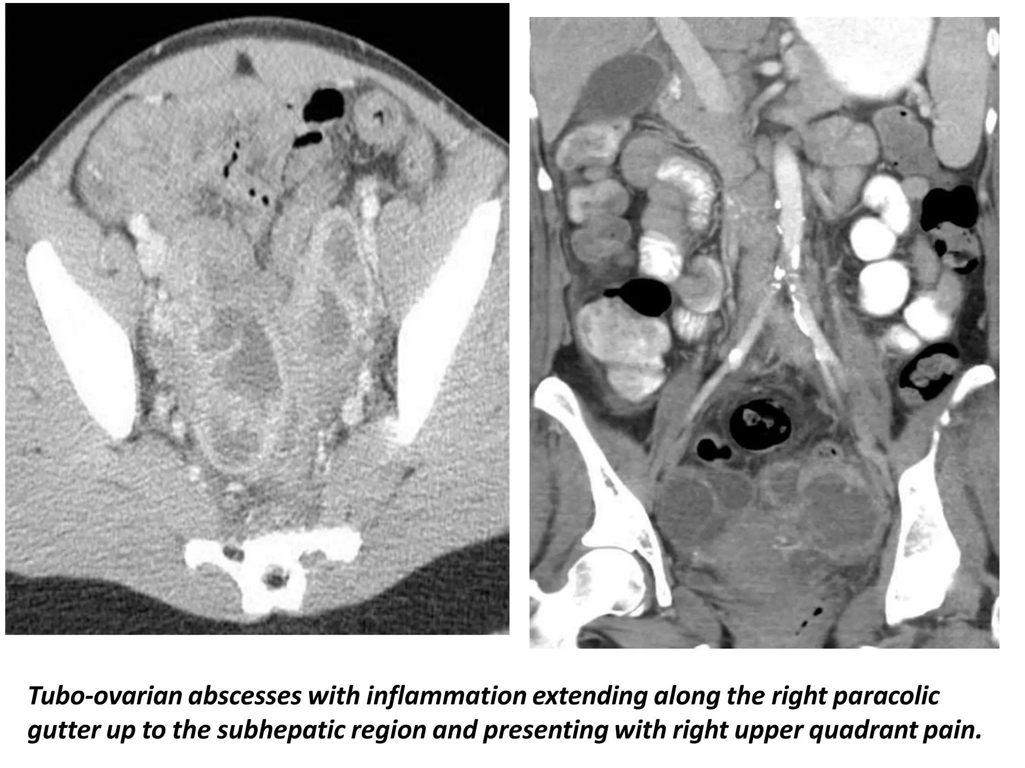 ovarian mass evaluation in radiology .pptx
