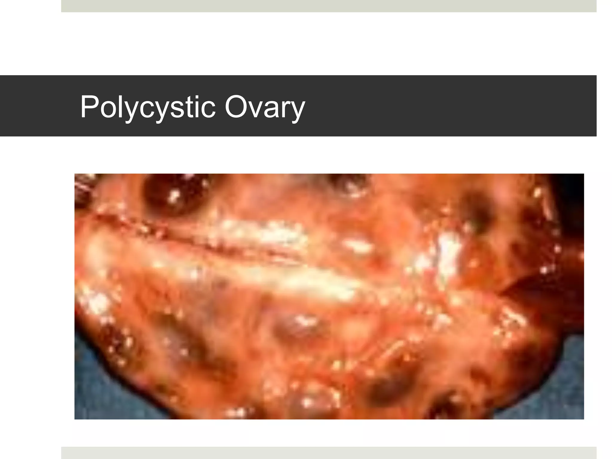 Ovarian Polycystis Syndrome Ppt