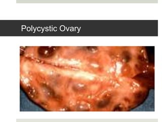 Ovarian polycystis syndrome | PPTX | Hormonal Disorders | Endocrine and ...