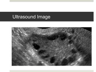 Ovarian polycystis syndrome | PPTX | Hormonal Disorders | Endocrine and ...