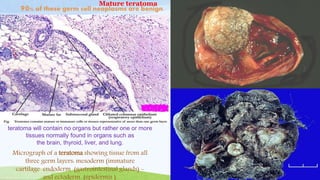 Ovarian Tumors | PPTX