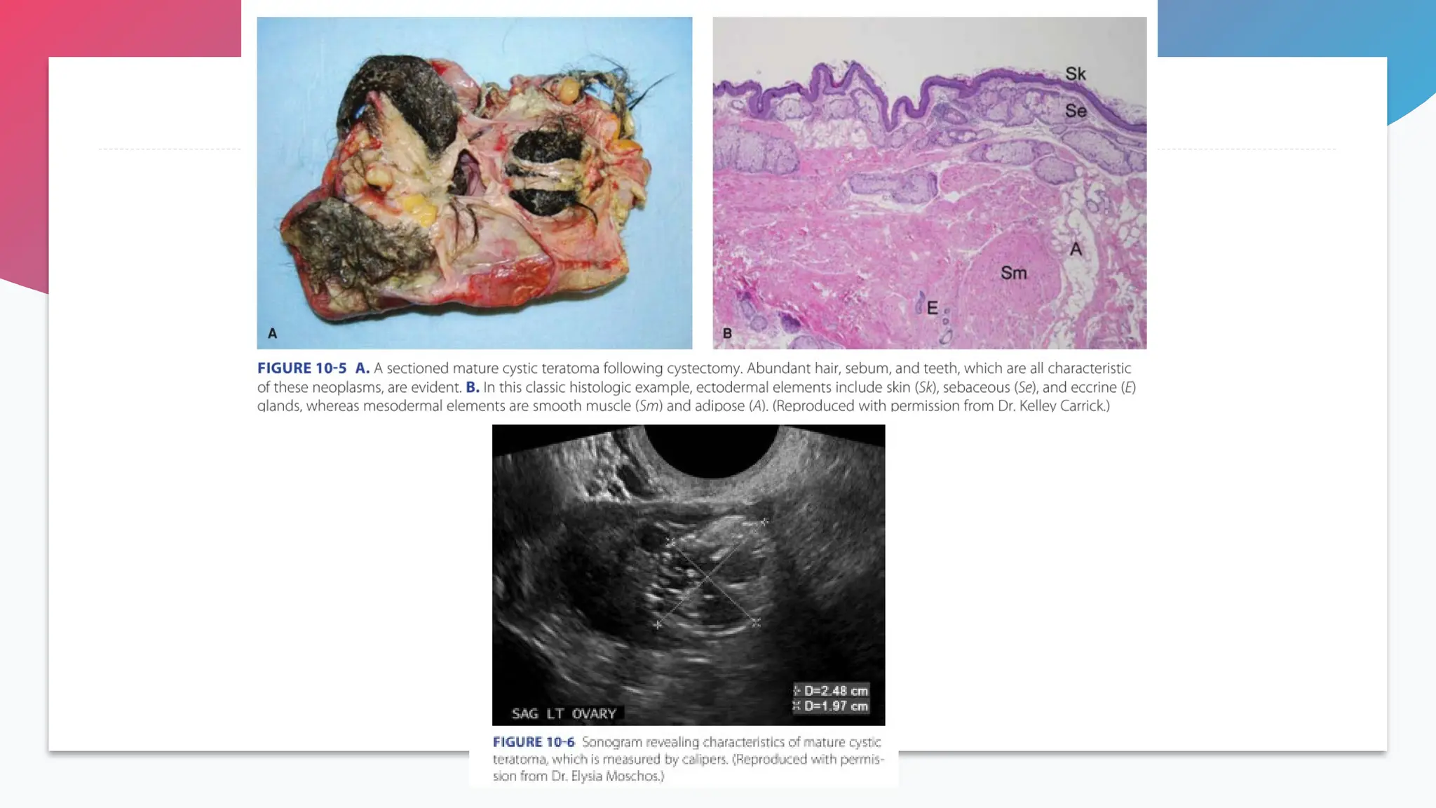 Ovarian teratoma matur dan imatur dari william ginekologi.pptx