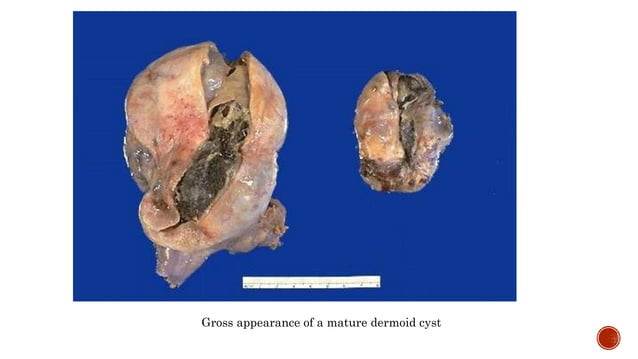 Ovarian teratoma | PPTX