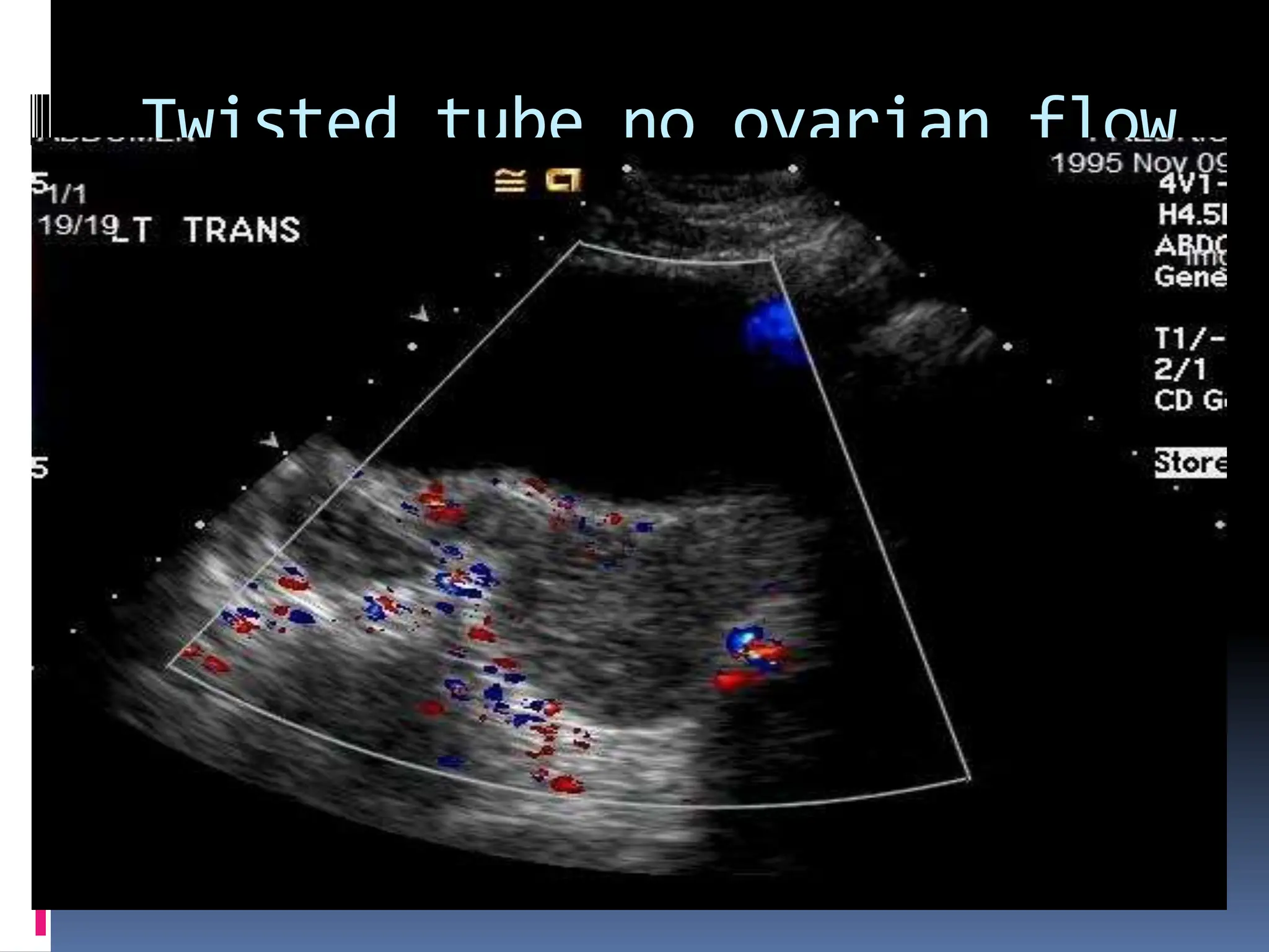 Ovarian Torsion.pptx