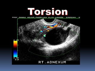 Ovarian Torsion.pptx