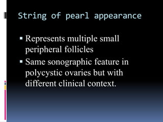 Ovarian Torsion.pptx