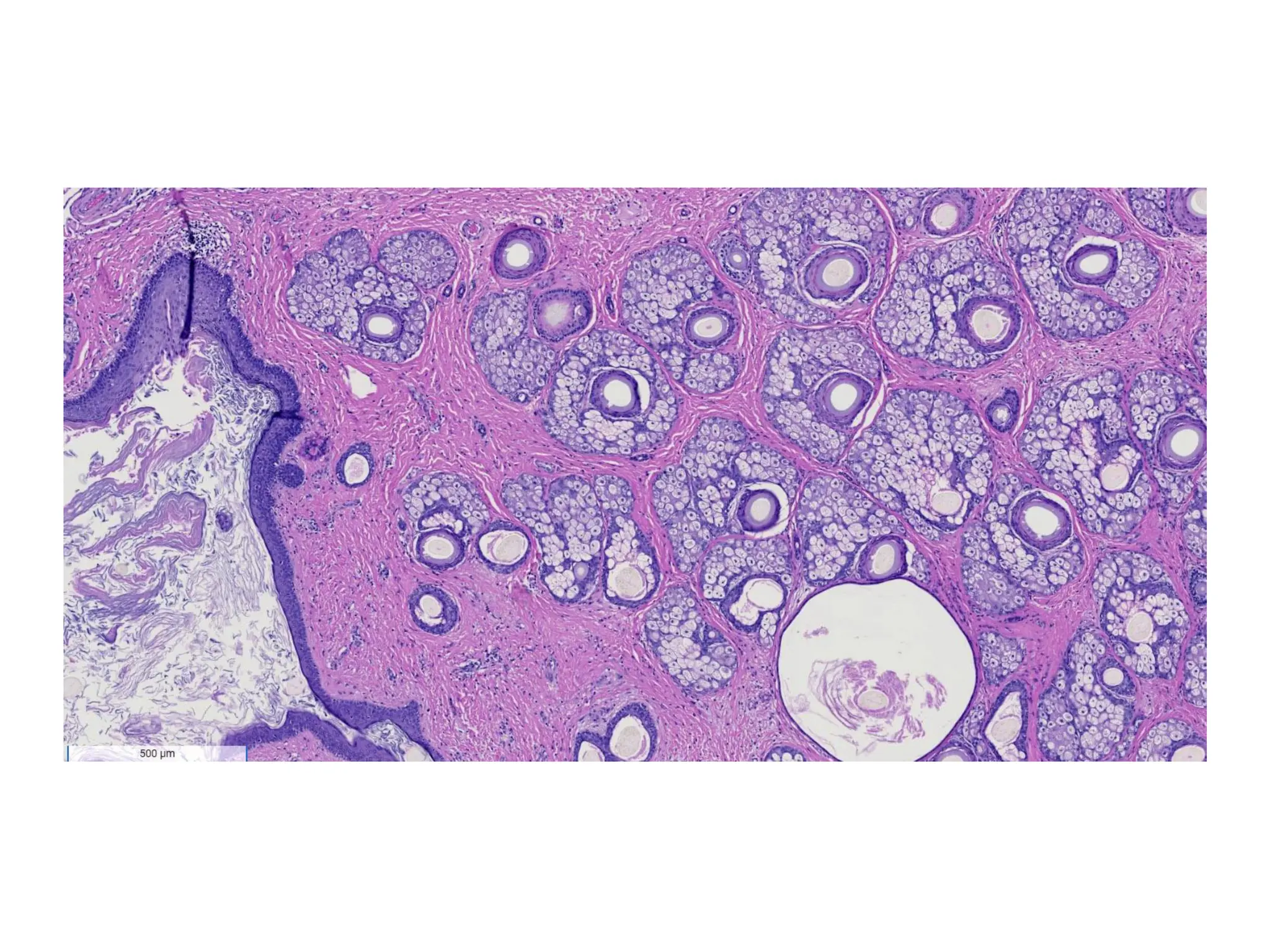 Ovarian tumor MBBS pathology lecture.pdf