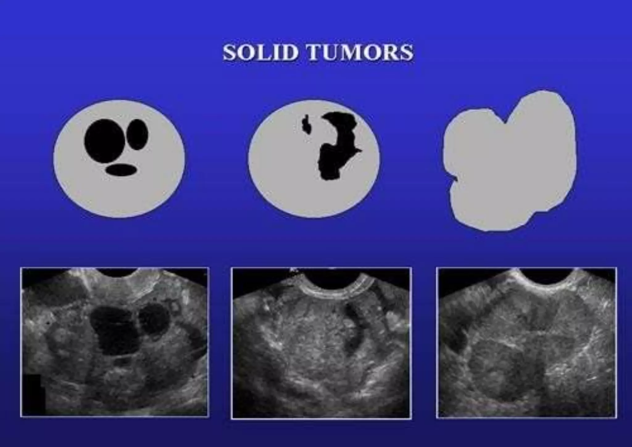 Ovarian tumor analysis | PPTX