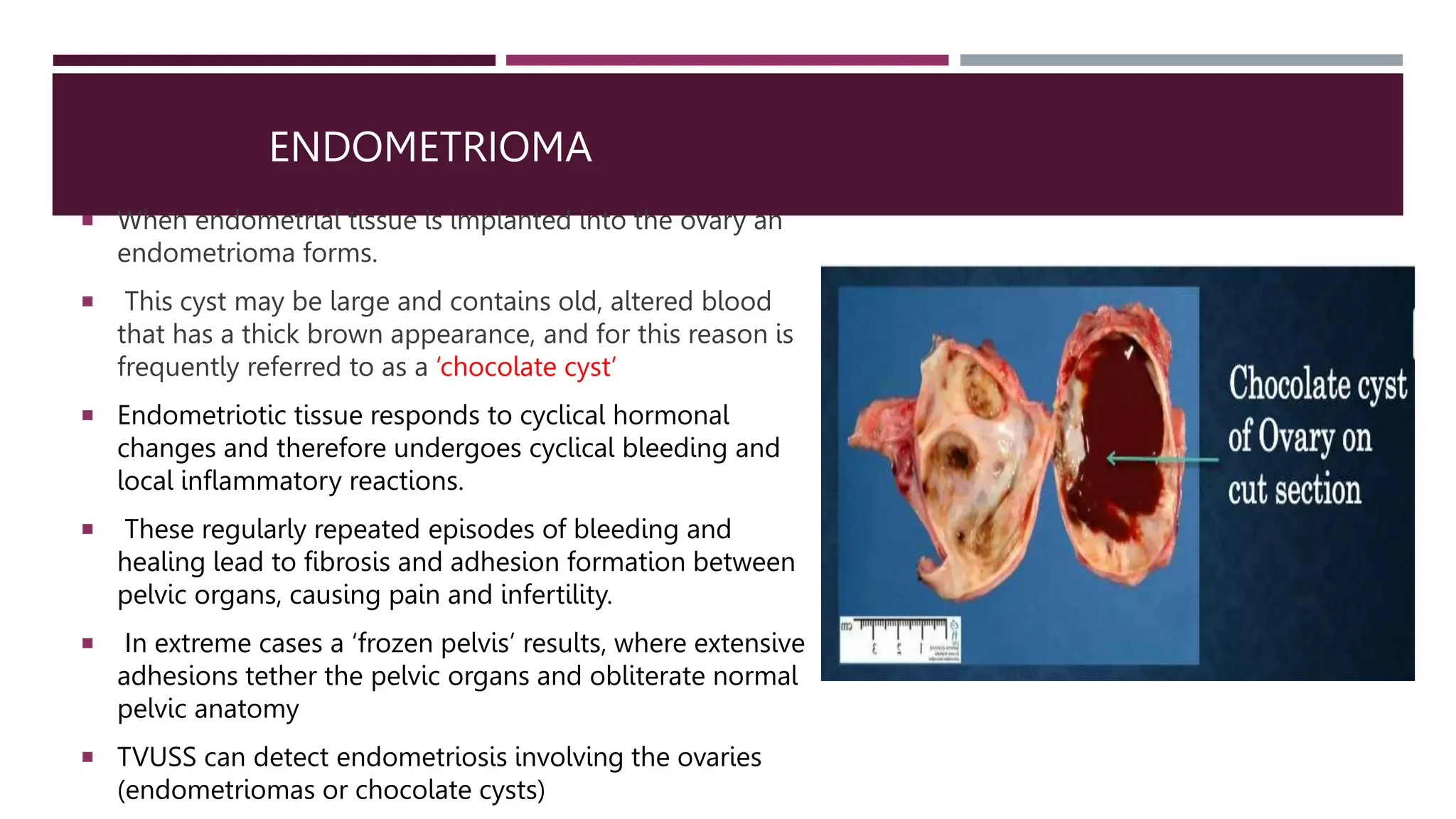 Ovarian Tumors 2.pptx gynecology lecture | PPTX