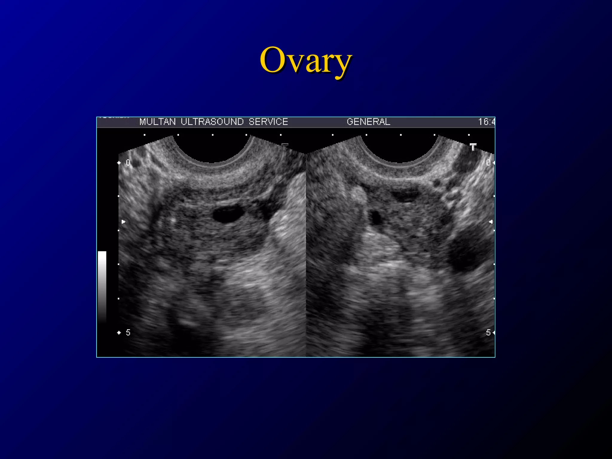 Ultrasound of ovaries | PPT