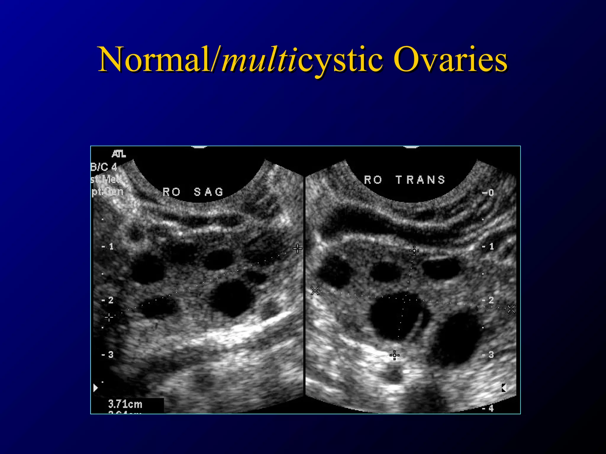 Ultrasound of ovaries | PPT