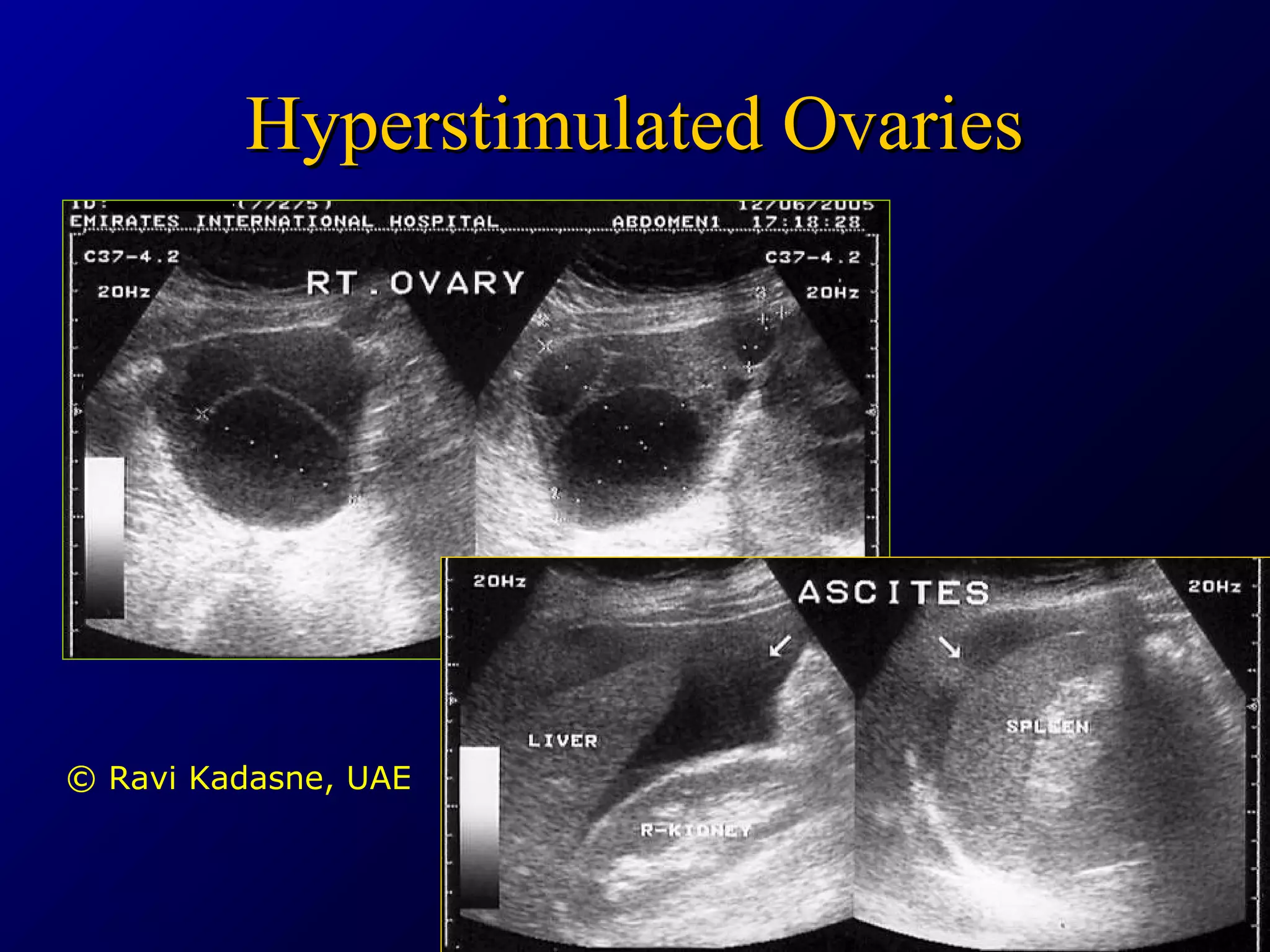 Ultrasound of ovaries | PPT