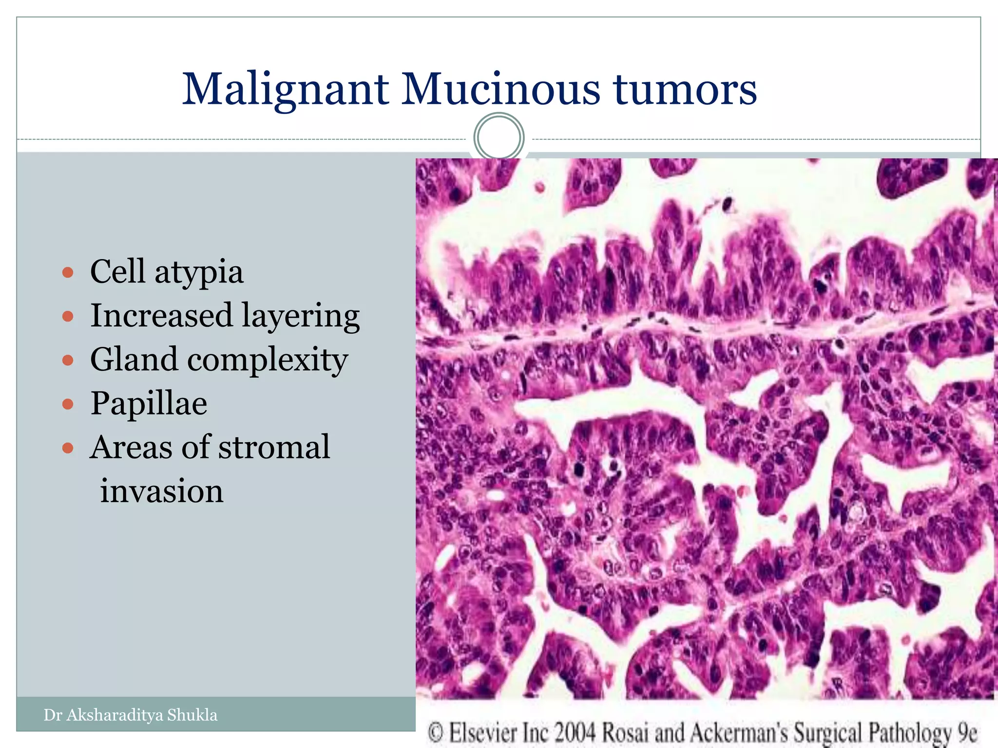Ovarian tumors I | PPTX