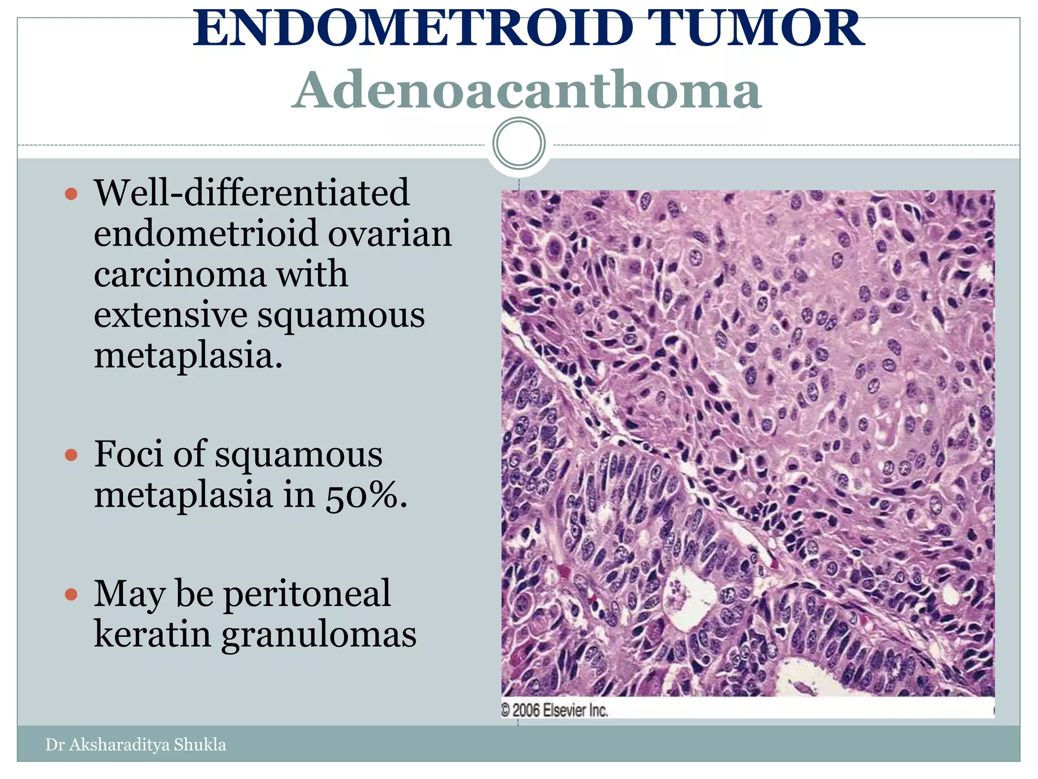 Ovarian tumors I | PPTX