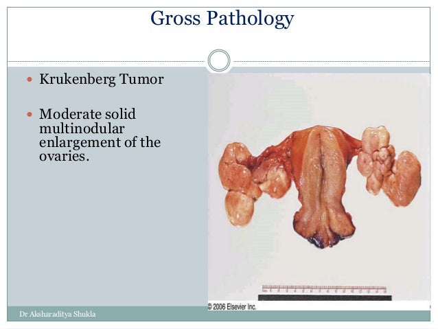 Ovary slide share 3