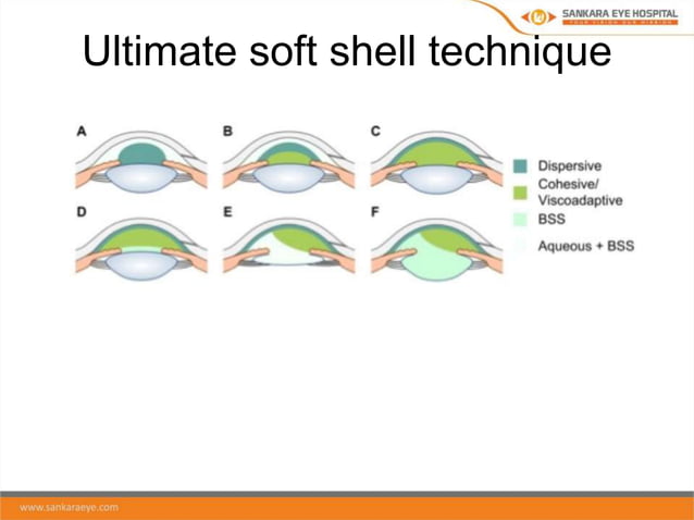 ophthalmic viscosurgical devices | PPTX | Eye and Vision Conditions ...