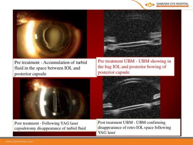 ophthalmic viscosurgical devices | PPTX | Eye and Vision Conditions ...