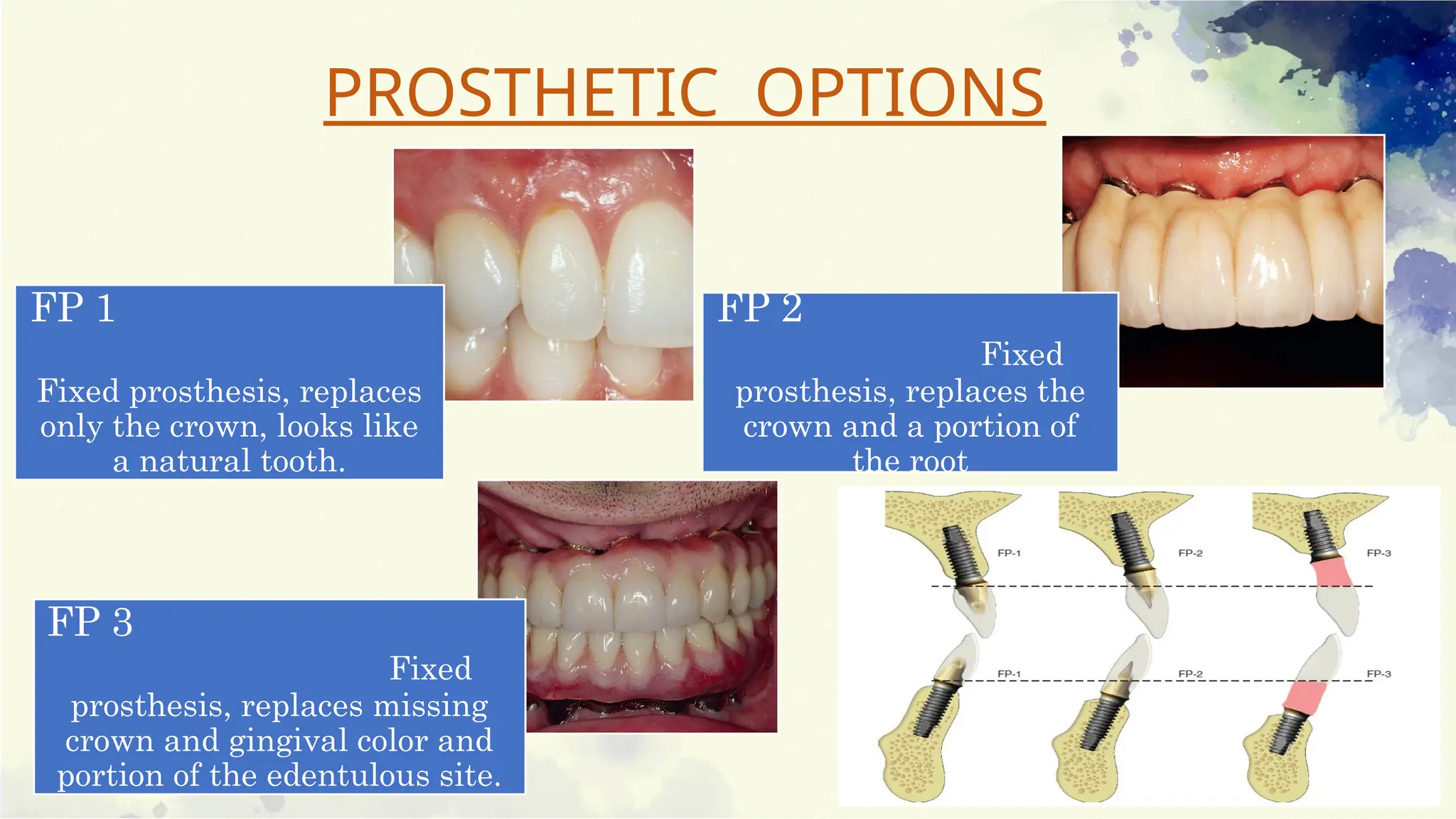 Implant supported overdenture, overdenture, implant occlusion, steps | PPTX