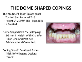 Over-Dentures PROSTHO and Attachments.pptx