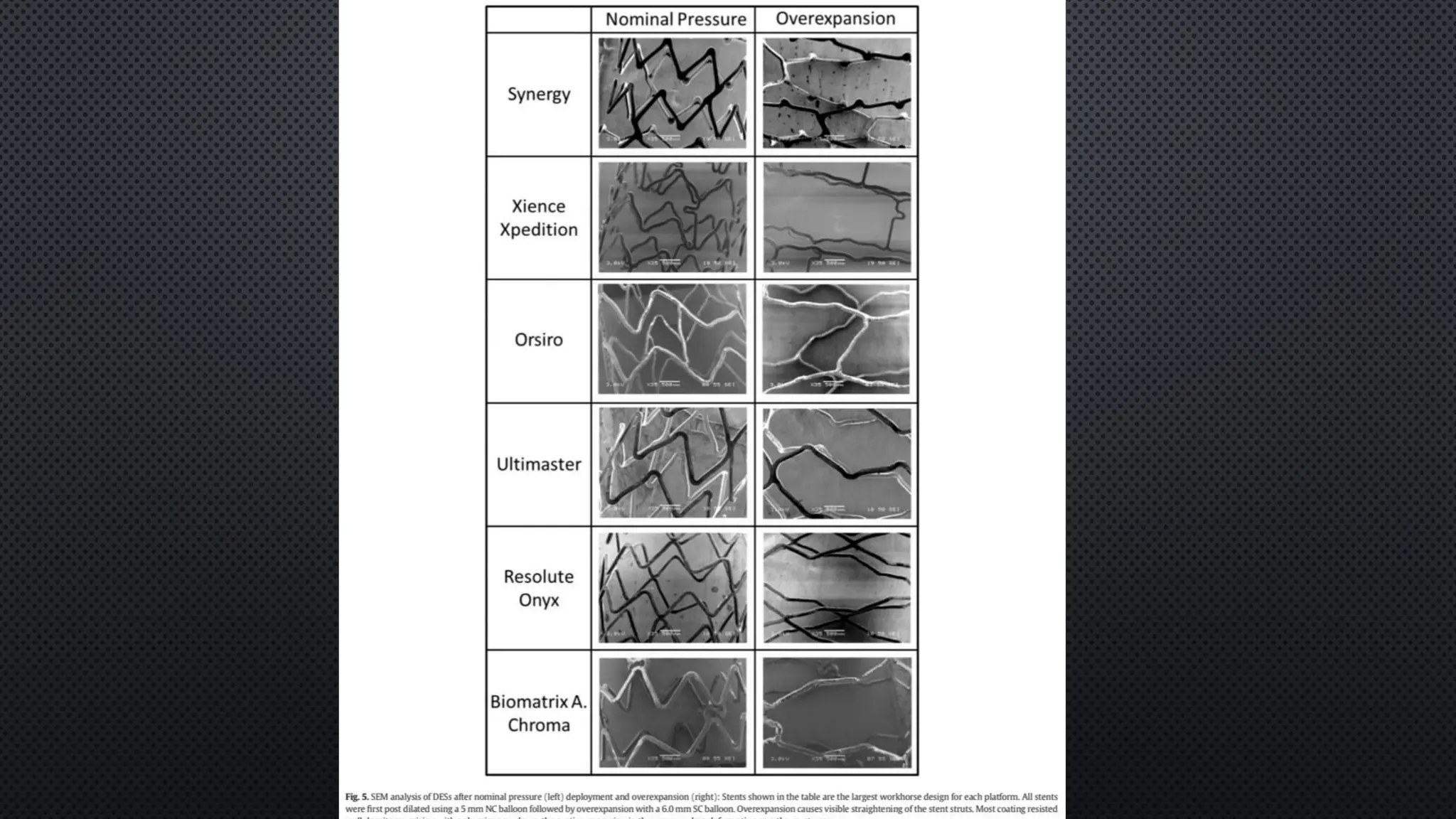 Over-expansion capacity and stent design model.pptx
