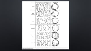 Over-expansion capacity and stent design model.pptx
