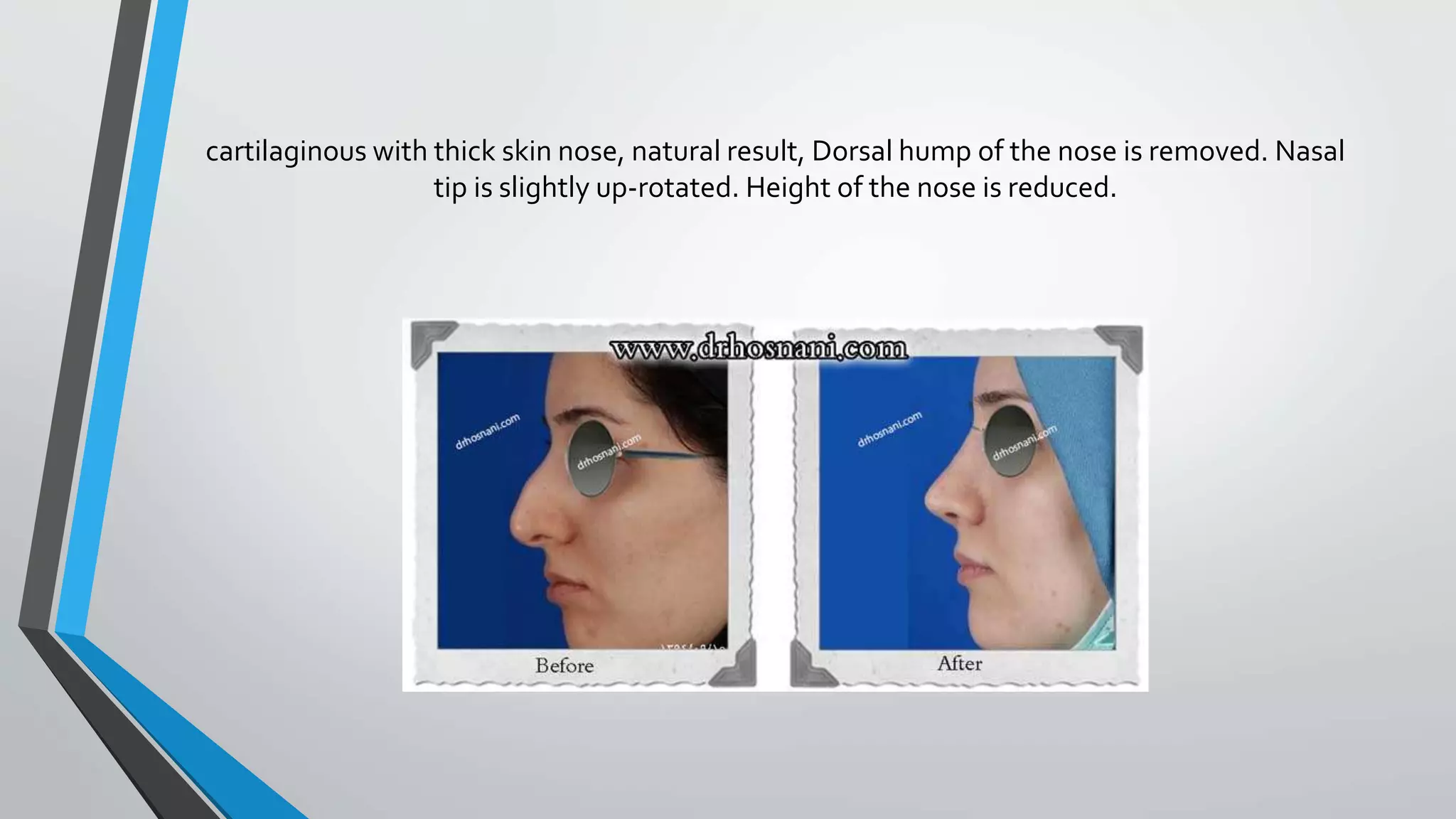 Over -hanging nose fix by rhinoplasty | PPTX