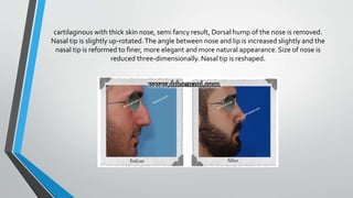 Over -hanging nose fix by rhinoplasty | PPTX | Ear, Nose and Throat ...