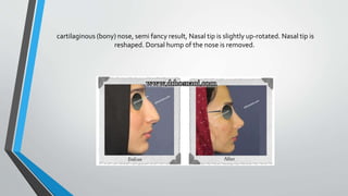 Over -hanging nose fix by rhinoplasty | PPTX