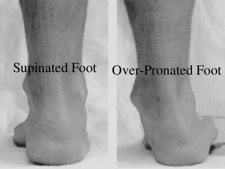 Over-pronation Hyperpronation