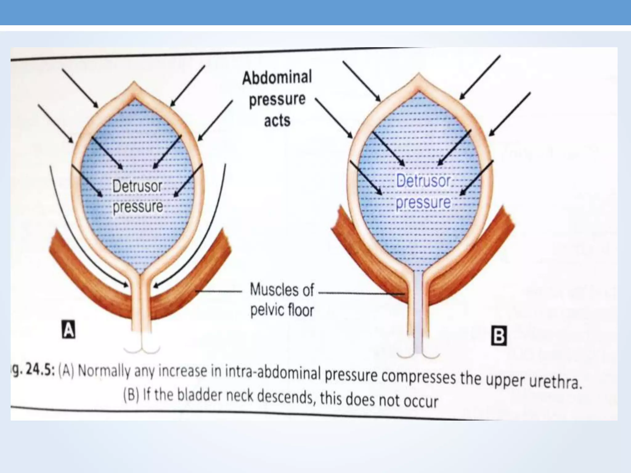 Overactive bladder | PPTX