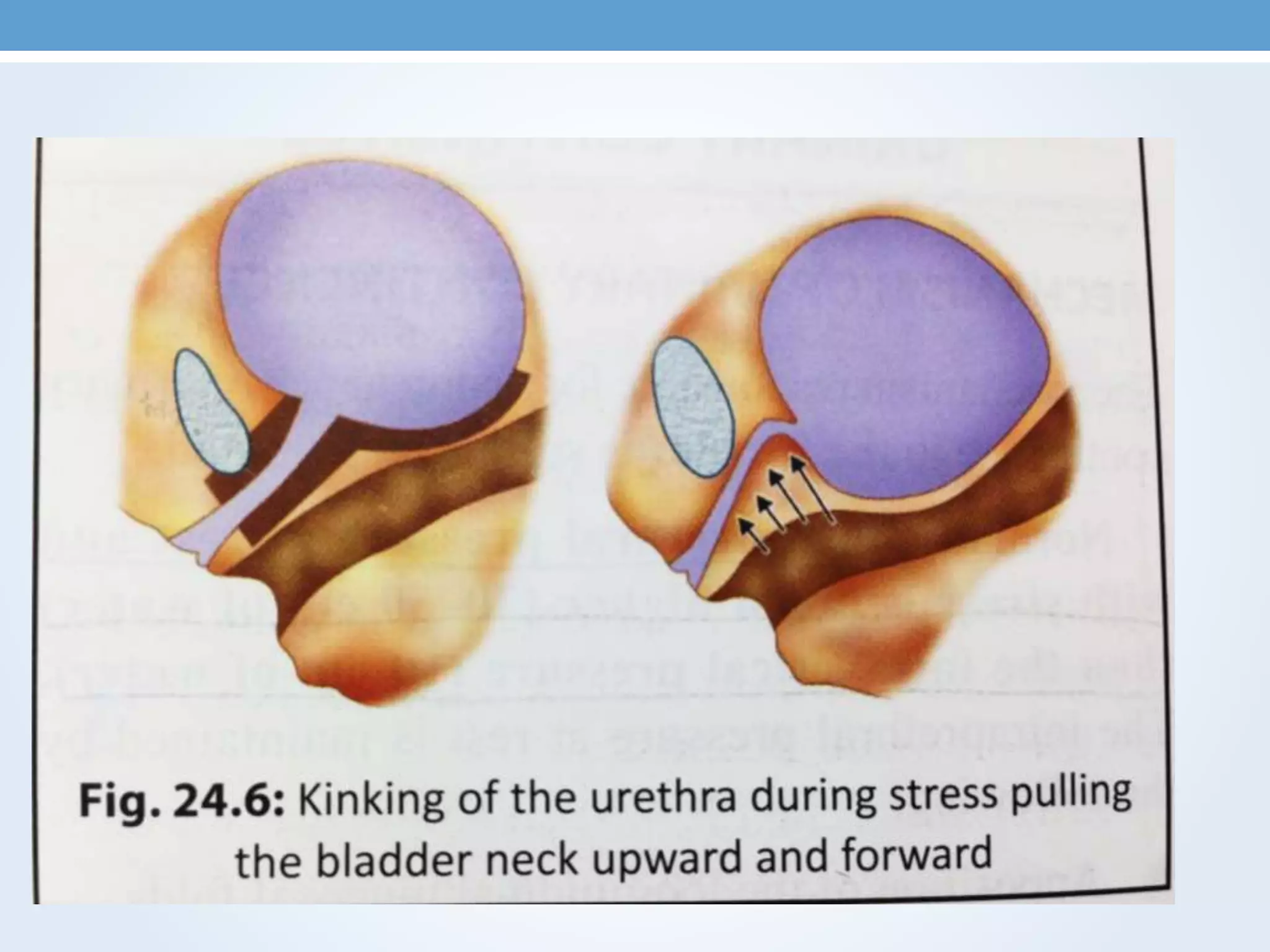 Overactive bladder | PPTX