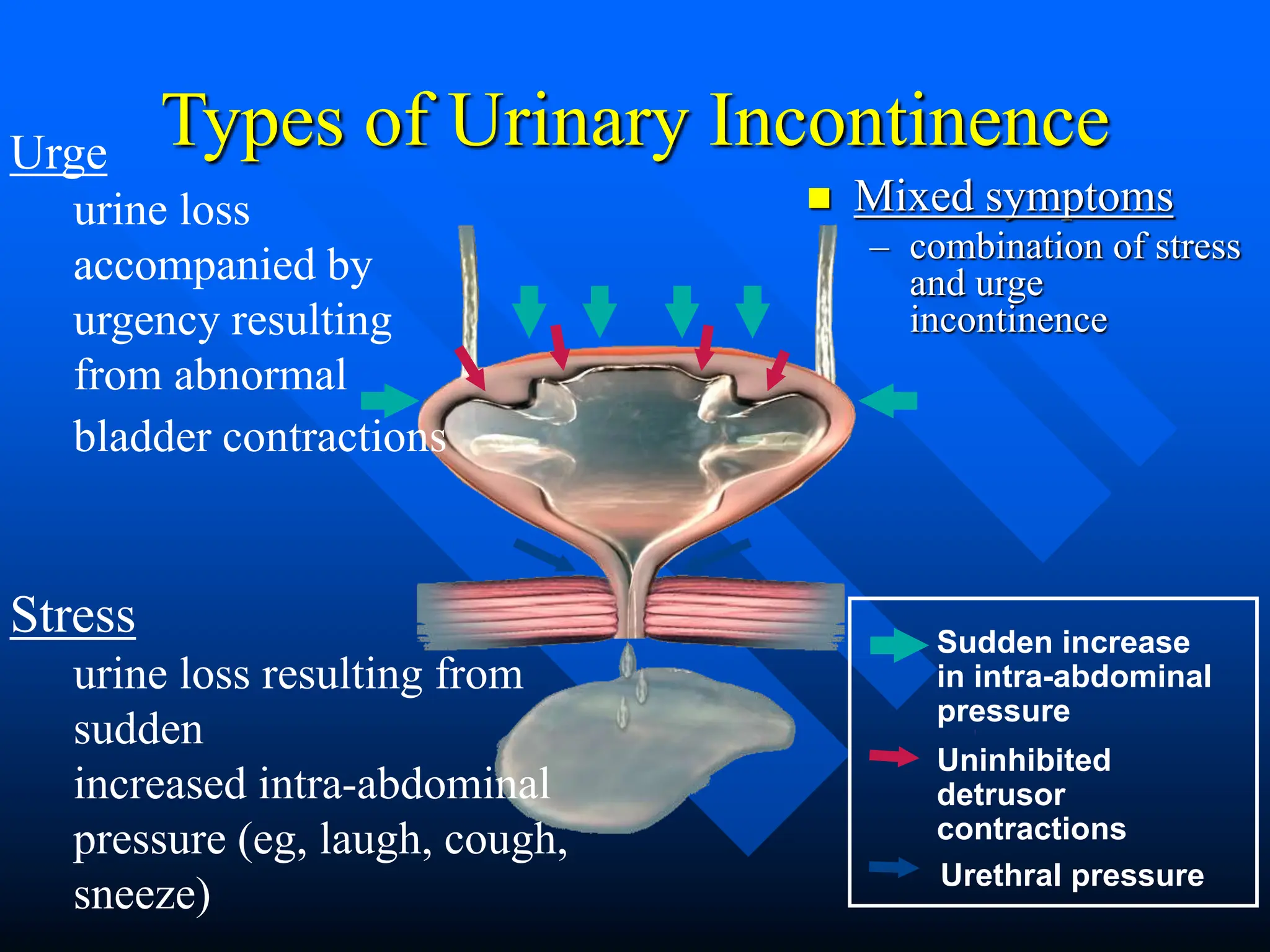 Overactive_Bladder management plane.ppt
