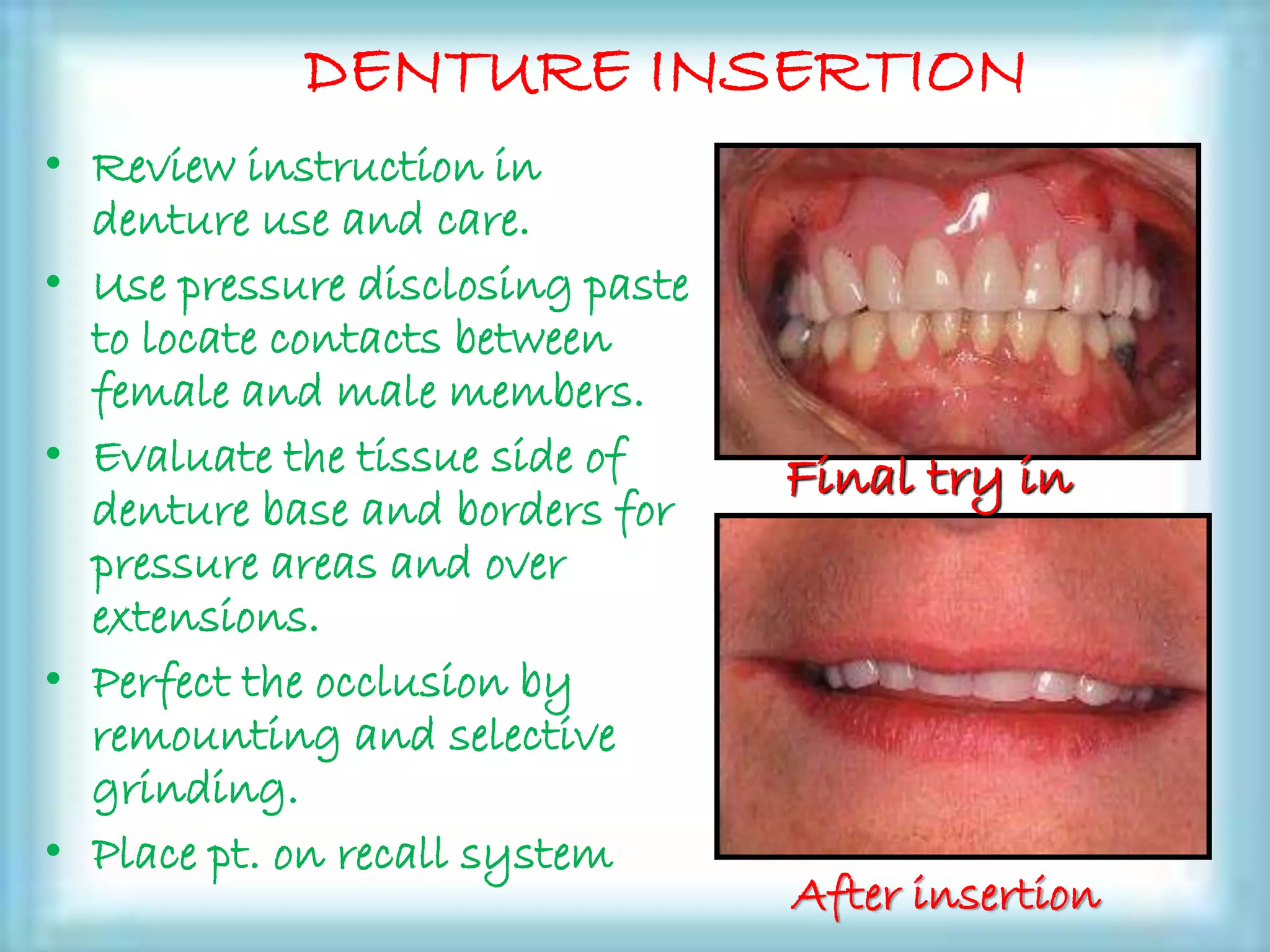 Overdenture | PPTX