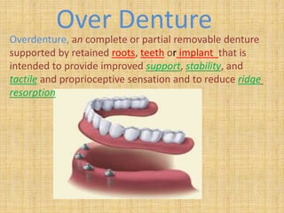 Over denture | PPT
