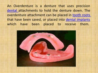 Over denture | PPT