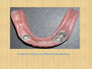 Over denture | PPT | Free Download