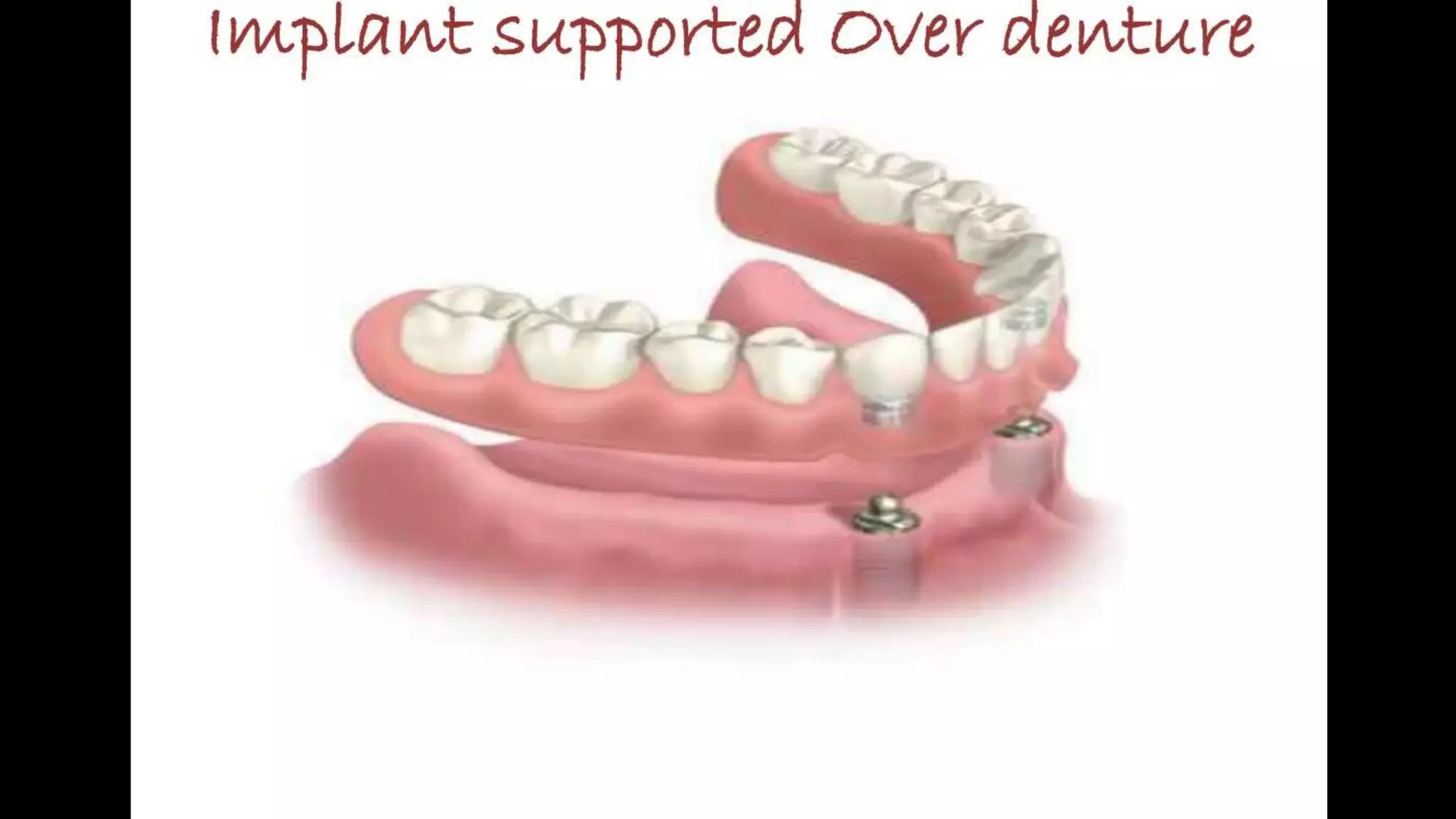 OVERDENTURE.pptx