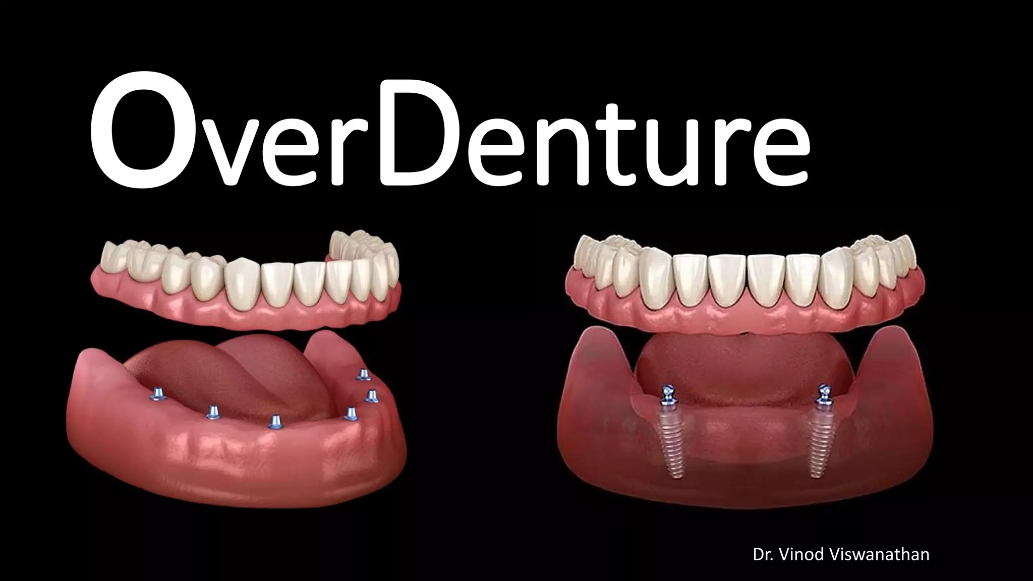 OVERDENTURE.pptx