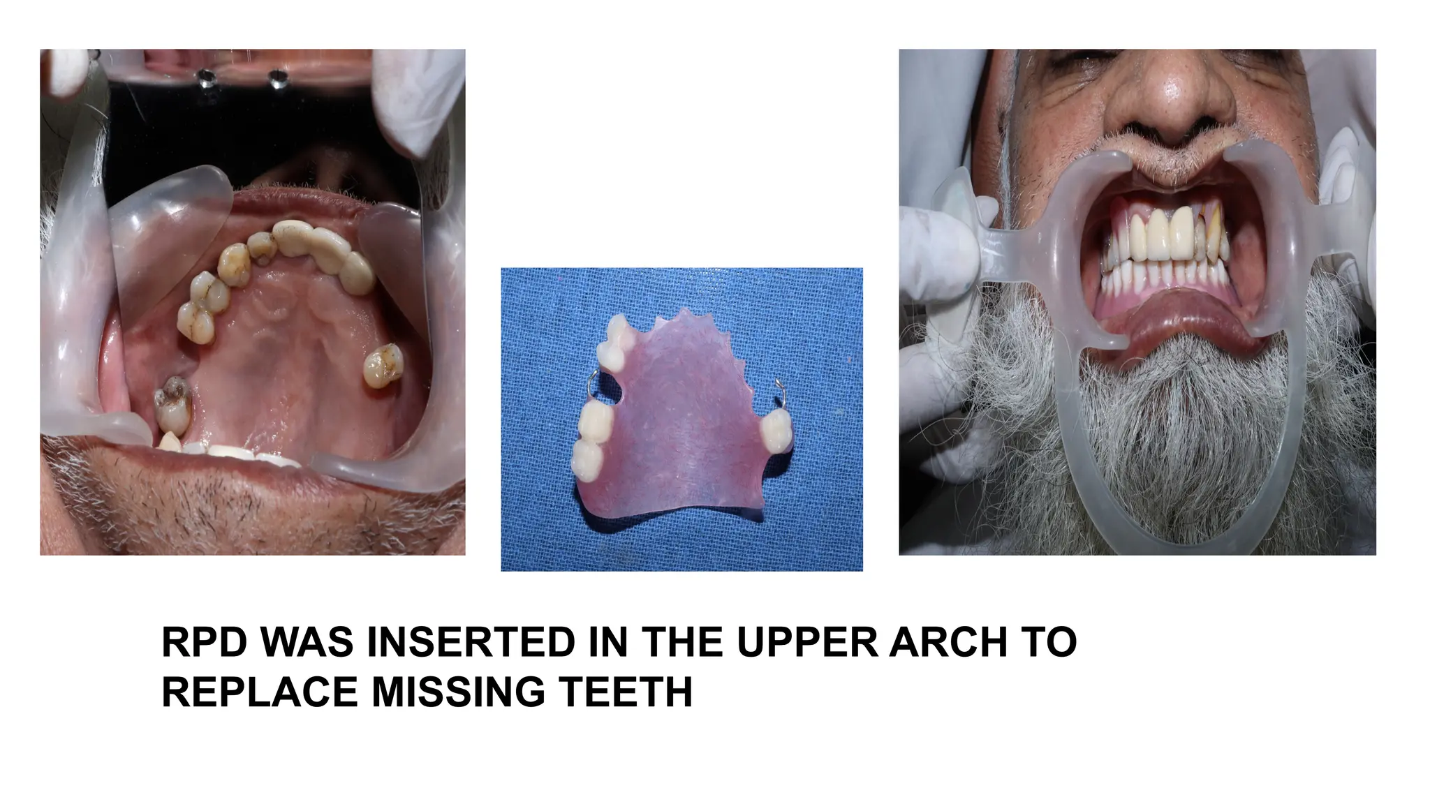 OVERDENTURE.pptx implant supported prosthesis | PPTX