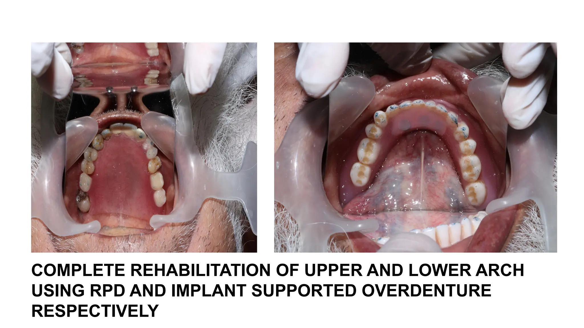 OVERDENTURE.pptx implant supported prosthesis | PPTX