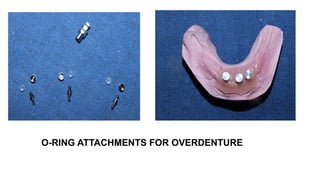 OVERDENTURE.pptx implant supported prosthesis | PPTX | Dental Health ...