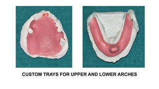 OVERDENTURE.pptx implant supported prosthesis | PPTX