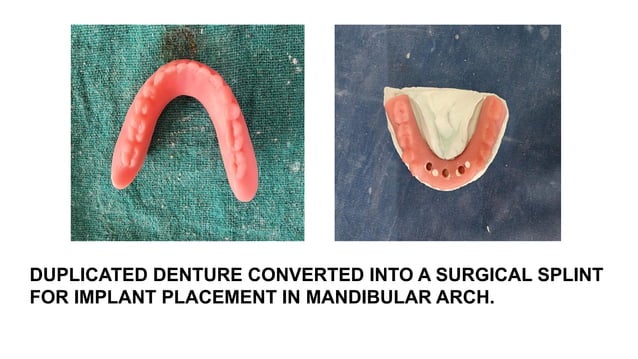 OVERDENTURE.pptx implant supported prosthesis | PPTX | Dental Health ...