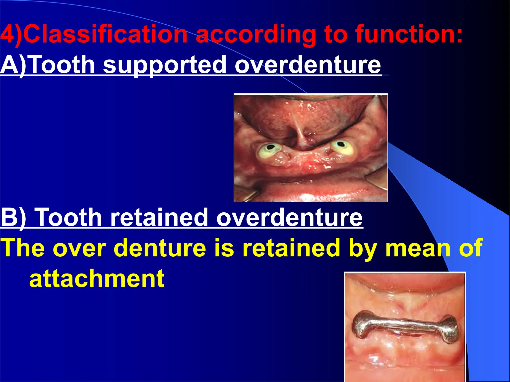 overdenture&attachment.pptx dentistry field | PPTX