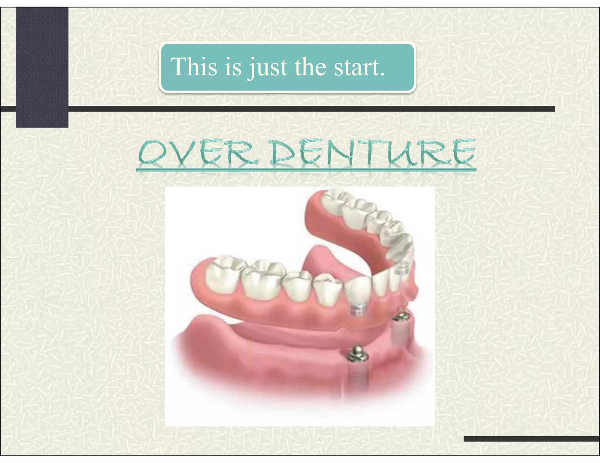 Over denture | PDF
